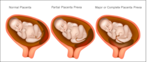 Low Lying Placenta: What You Need to Know