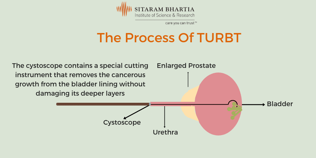 TURBT Sitaram Bhartia Institute Of Science And Research turbt-sitaram-bhartia-institute-of-science-and-research