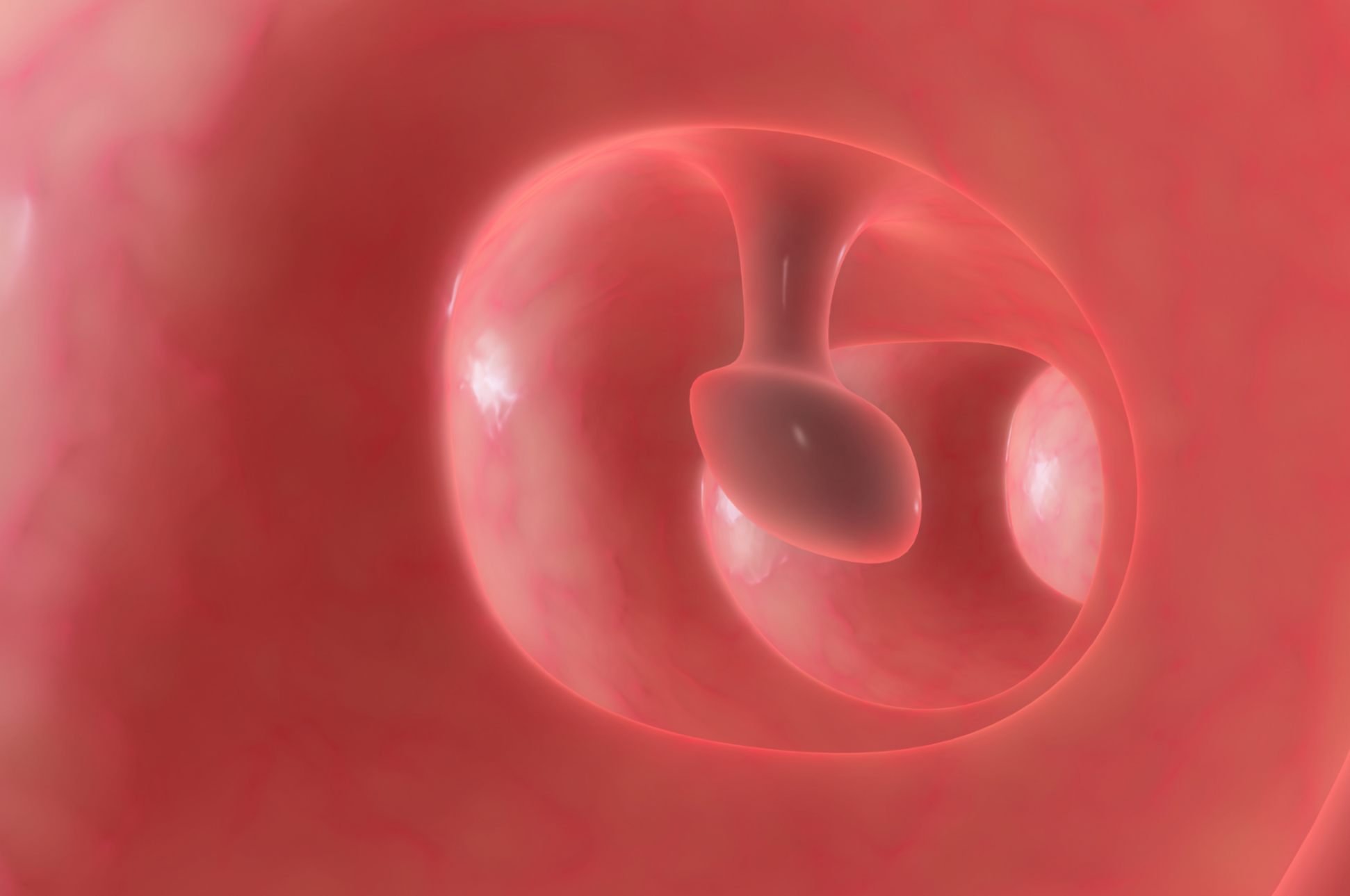 Don’t Be Afraid of a Polypectomy! Here’s What to Know - Sitaram Bhartia ...