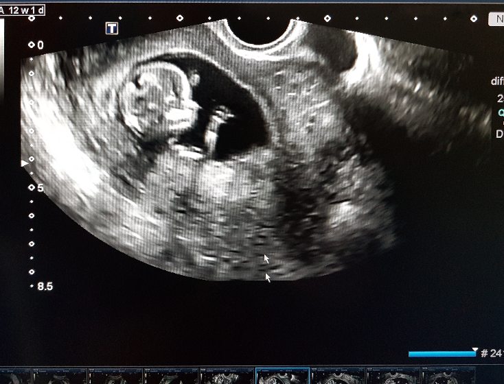 First Trimester Screening: What, When and Why To Get It Done - Sitaram ...